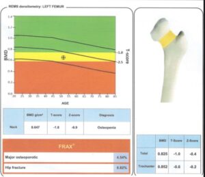 Learn About Our Revolutionary Bone Density Scan That Uses Free of ...